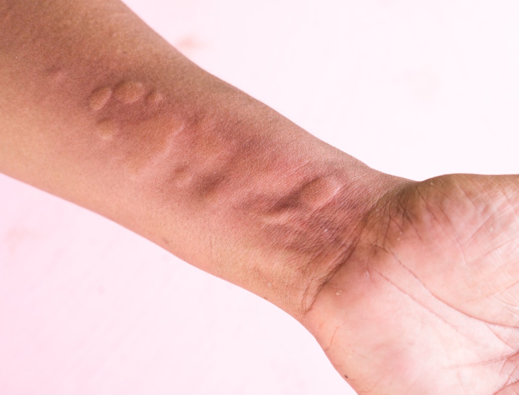 Bee Sting: This Is What Happens to Your Body When You Get Stung by a ...