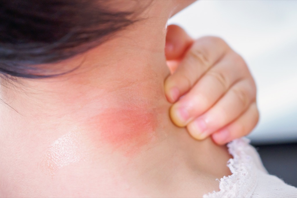 17 Signs Your Bug Bite Is Something Serious — Best Life