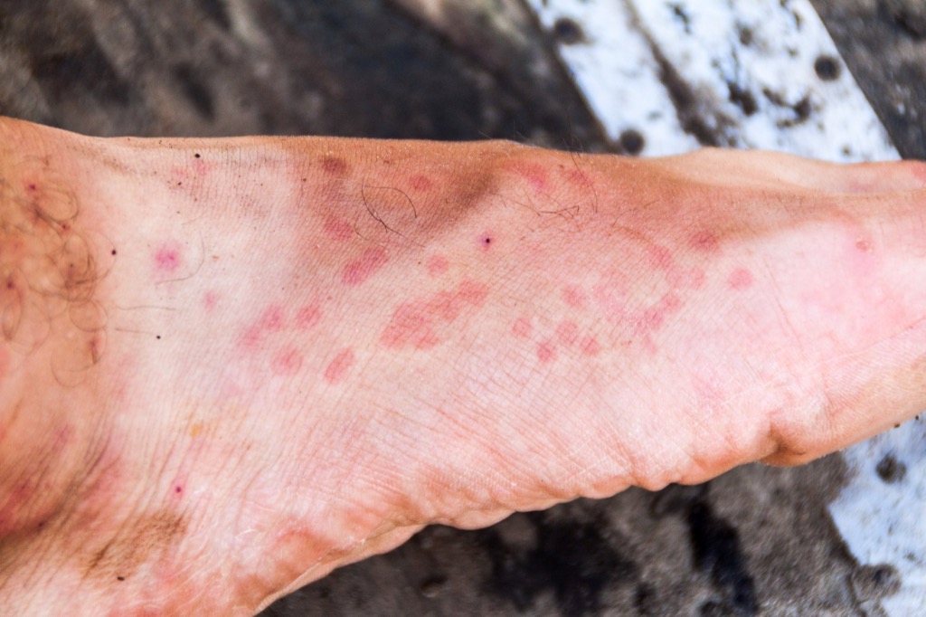 17 Signs Your Bug Bite Is Something Serious — Best Life
