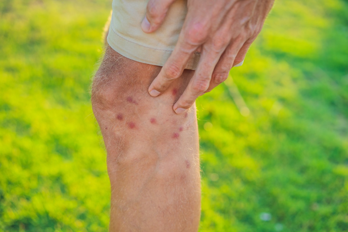 Ulcer-Causing Leishmaniasis Spreading in U.S., CDC Warns — Best Life