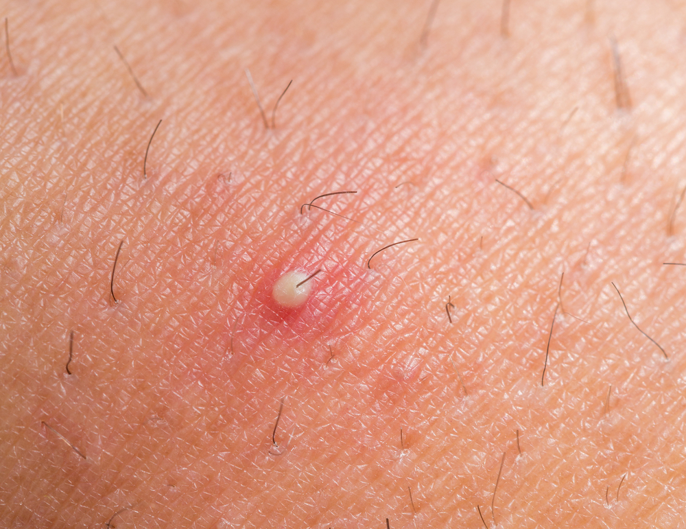 I'm a Dermatologist and Here's How I Never Get Ingrown Hairs — Best Life