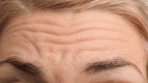 How to Get Rid of Forehead Wrinkles: 18 Dermatologist Tips — Best Life