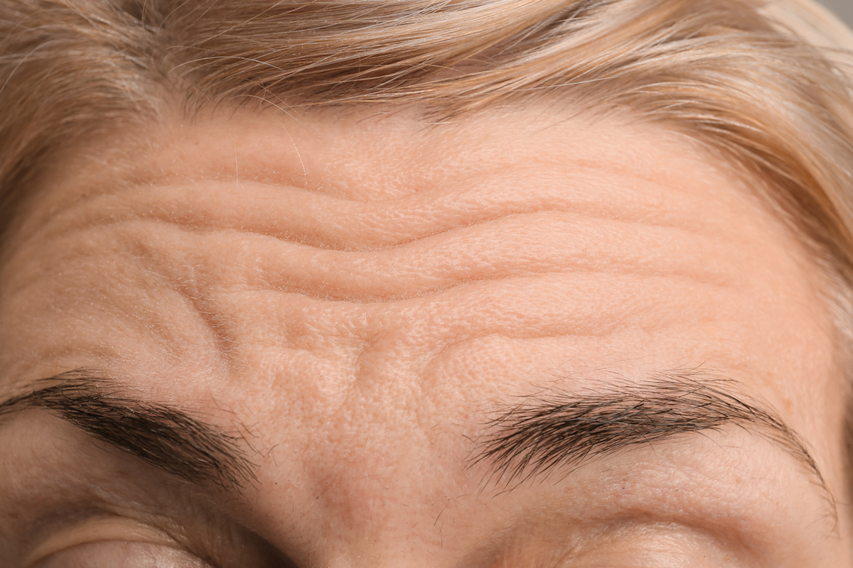 How to Get Rid of Forehead Wrinkles: 18 Dermatologist Tips — Best Life