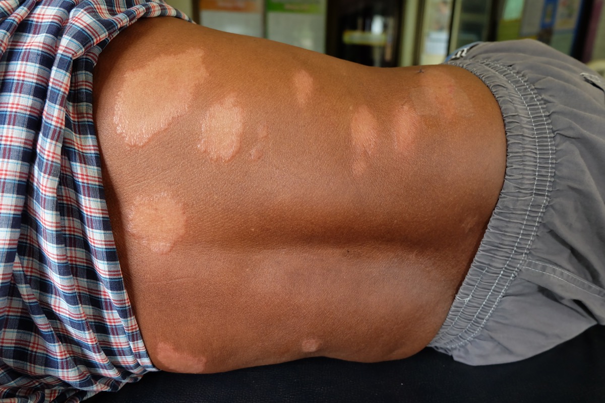 Leprosy Cases Are on the Rise: These Are the Symptoms to Know — Best Life