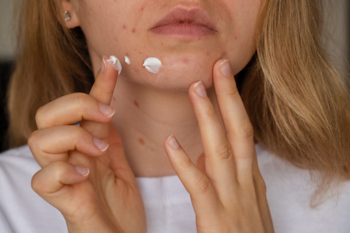 Walgreens and Target Acne Creams Have High Levels of Benzene