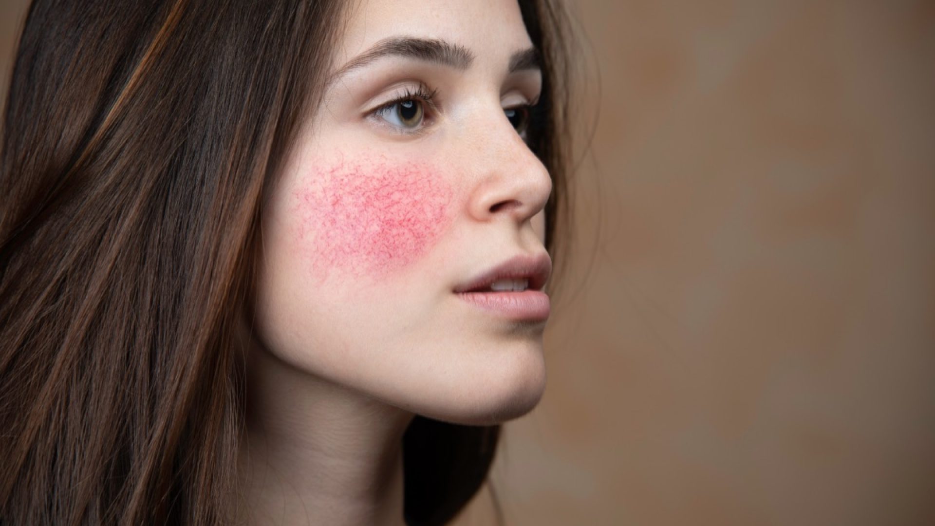 How to Get Rid of Rosacea: 10 Natural Remedies — Best Life