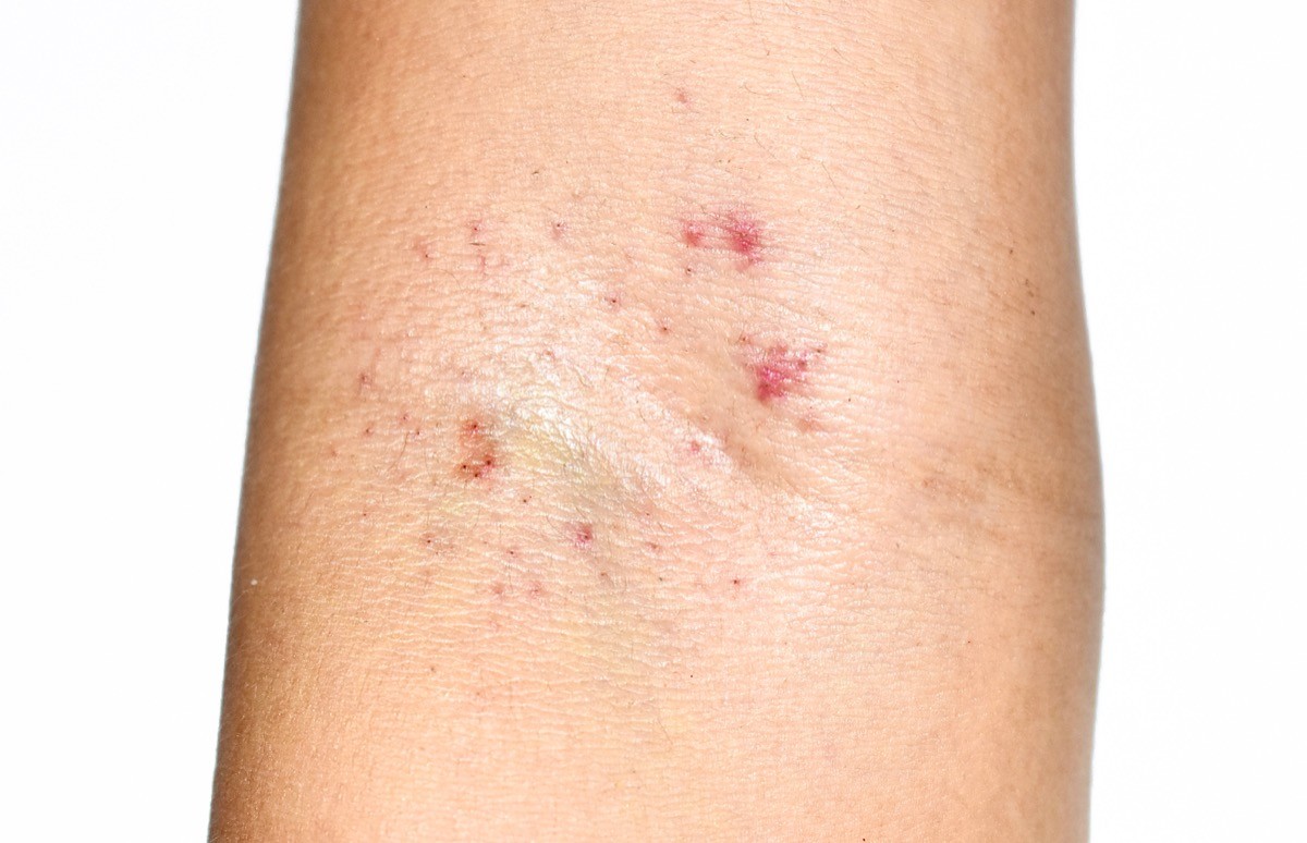 7 Surprising Signs You Have a Vitamin K Deficiency